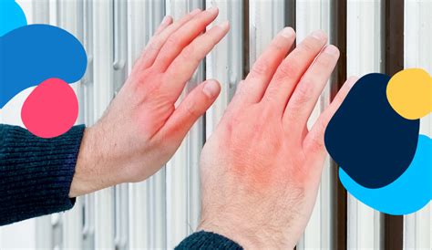 Geloni: sintomi, cause, cure, prevenzione | Doctolib