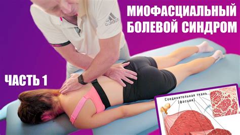 МФС. Миофасциальный болевой синдром. Myofascial pain syndrome ...