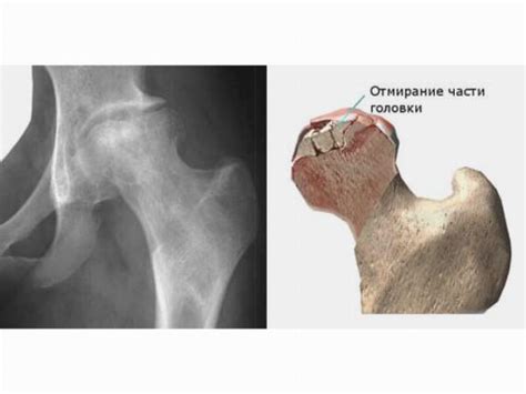 Боли в тазобедренном суставе: причины | Народная медицина диагностика и ...