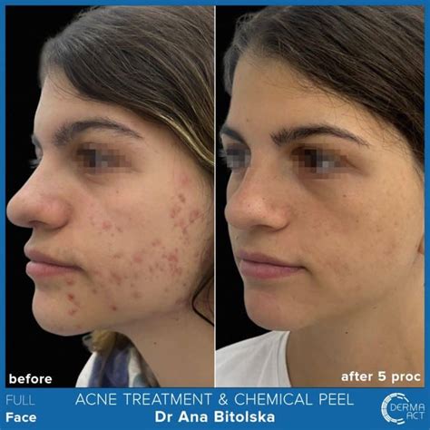 Гъбички по ноктите - локализиране и лечение | Derma-Act