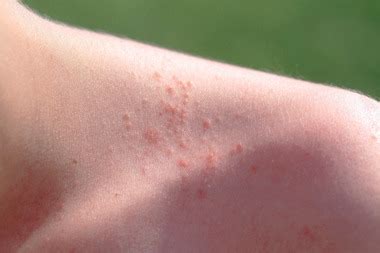 Heat Rash Legs