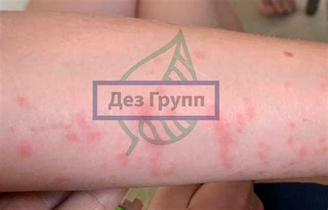 Укусы клопов на теле: чем опасны, как выглядят, аллергия, чем лечить