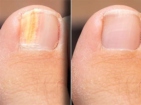Fungal nail treatment - First Health Medical and Skincare