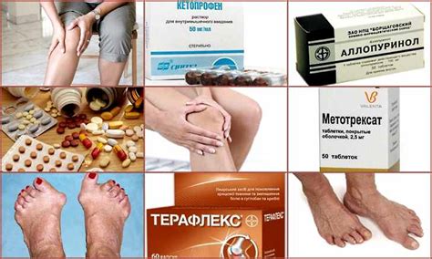 Артрит суставов: медикаментозное лечение, препараты и народные рецепты