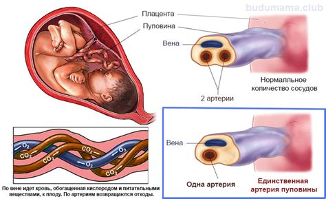 Единственная артерия пуповины – два сосуда вместе трех