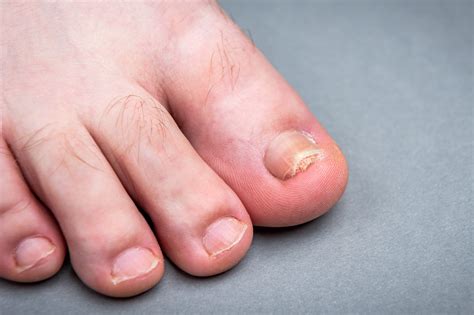 CLEARANAIL Fungal Nail Treatment - Cutting Edge Podiatry
