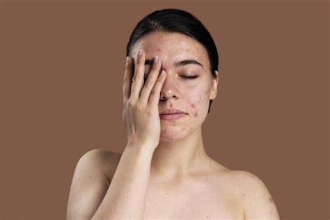 Blemishes|Types of blemishes|Colour guide of blemishes