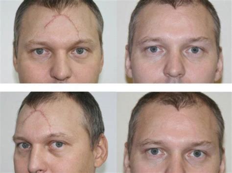 10 способов как убрать шрамы на лице в домашних условиях и современными ...