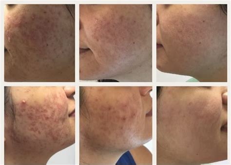 DERMAPEN
