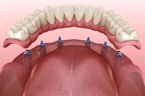 Sześć w jednym czyli kilka słów o implantach all on 6 - Nowe Zęby