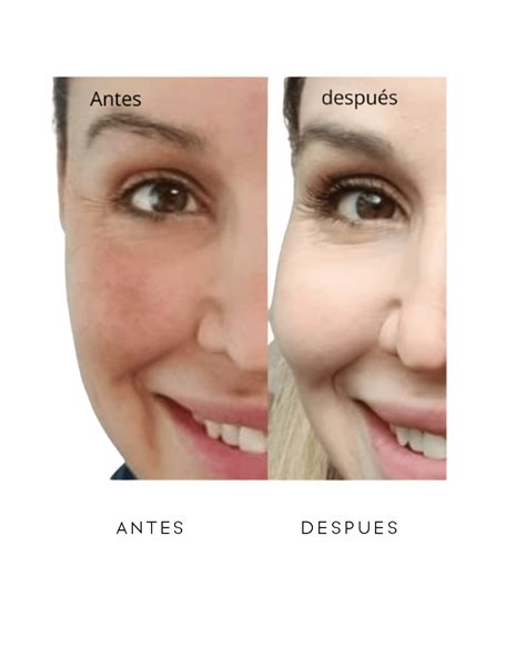 Hollywood peel - Vivante Medicina Estética