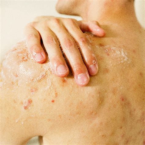 Salicylic Acid – Oxy® Acne Care