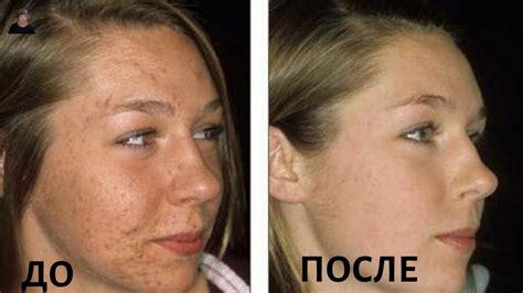 Раскрыт секрет/ Как СДЕЛАТЬ ГЛУБОКИЙ ПИЛИНГ ЛИЦА БОДЯГОЙ в домашних ...