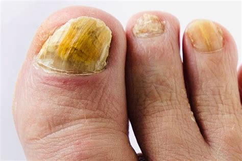 Fungal Nail Advisor - A Step Ahead Foot + Ankle Care
