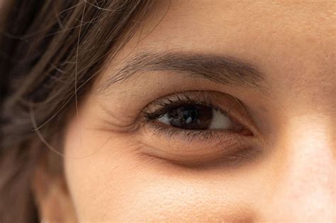 How To Get Rid Of Dark Eyebags Fast: Quick Fixes And Long-Term ...