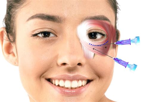 PDRN for dark circles and eye bags | Aestha Clinic