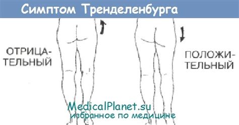 Что такое симптом Тренделенбурга?