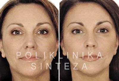 Mezoterapija i mezolift pomlađuju vašu kožu | poliklinika SINTEZA