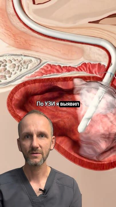 Мочевой катетер | Случай из практики #катетер #андролог - YouTube