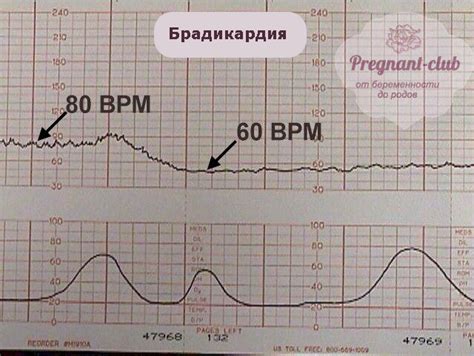 Частота сердцебиения плода (ЧСС): норма по неделям, тахикардия, брадикардия