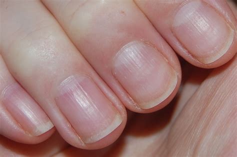 Полоски на ногтях их причины и лечение