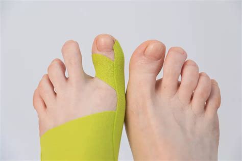 Халюс Вальгус - как лечить Hallux Valgus? Полезные статьи в блоге ...