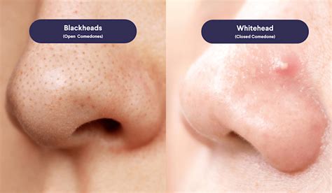 How to treat acne and blackheads like a pro