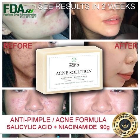 Yana Acne Solution with Niacinamide + Salicylic Acid Soap 90g | Shopee ...