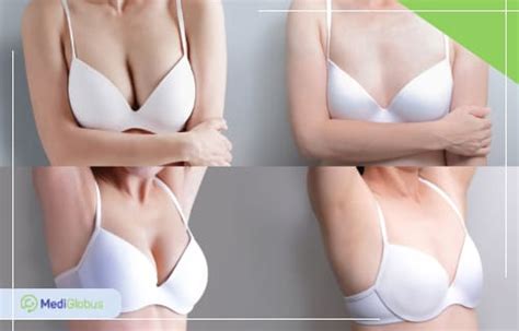 Где сделать пластику груди: цены, отзывы, фото | Medical Tourism with ...