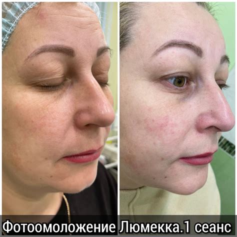 Цены на удаление пигментных пятен лазером - Аши, косметологическая клиника