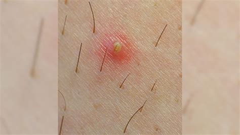 ingrown hair cyst - Dallascollege Innovation