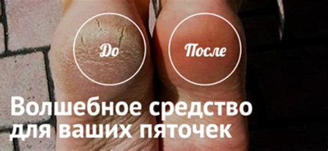 ВОЛШЕБНОЕ СРЕДСТВО ДЛЯ ВАШИХ ПЯТОЧЕК. ЭФФЕКТ ПОТРЯСАЮЩИЙ!