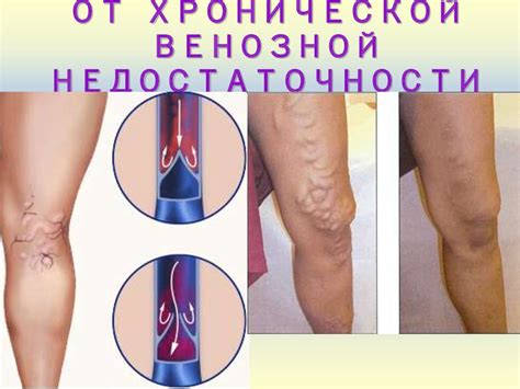 От хронической венозной недостаточности TopRelax - online presentation