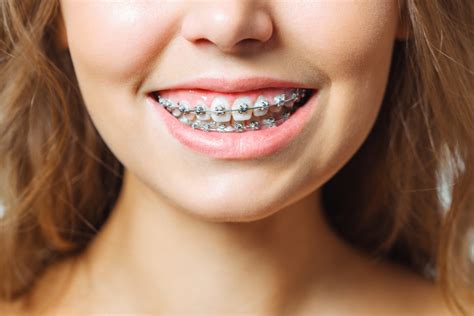 Orthodontics Newcastle | Treat Tooth Wear And Jaw Pain | Morrin Dental