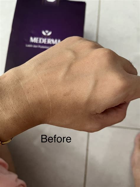 Mederma advanced Gel - fimela.com