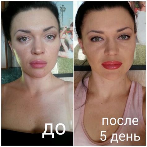 Губы После Ботокса 1 Мл Фото – Telegraph