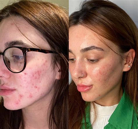 Chemical Peels | MediMD