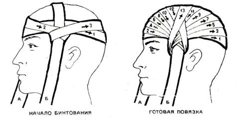 12. Наложить повязку "чепец".