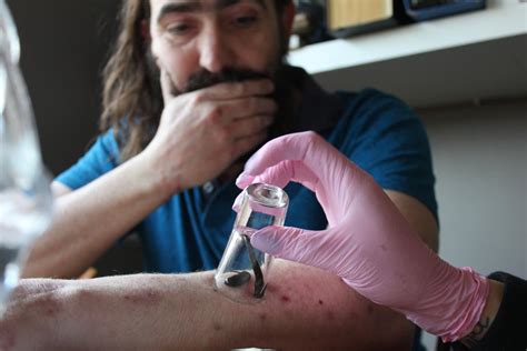 Leech therapy: What does it feel like and does it work?