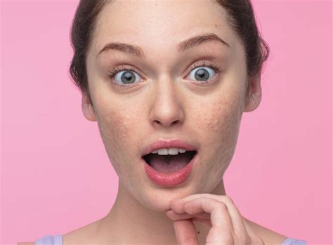 Sebiaclear Gel Cream for Acne & Blackhead-Prone Skin - Reduces ...