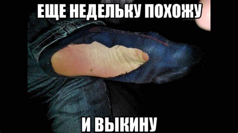 Мозоль на стопе болит мешает ходить как избавиться - YouTube