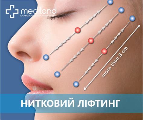 Тредлифтинг 3d мезонитями: Тредлифтинг 3D-мезонитями - длительный ...