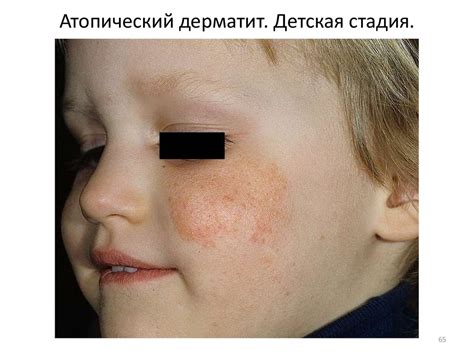 Зудящие дерматозы у детей. Почесуха. Атопический дерматит. Осложнения ...