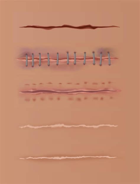 Premium Vector | Healing wounds set skin scars stitched gash and cuts ...