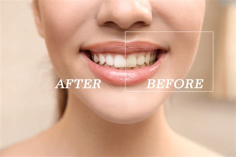 6 Benefits of Professional Teeth Whitening