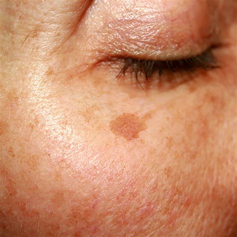 Sun Damage? Let's Fix that! - Nima Skin Institute