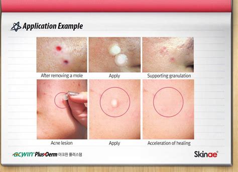 Acwin Plus Derm Acne Spot Pimple Patch 3-Pack - 204 Count Hydrocolloid ...