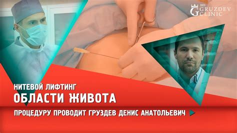 Нитевой лифтинг области живота - YouTube