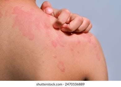 2 978 Urticaria Scratch Images, Stock Photos, 3D objects, & Vectors ...