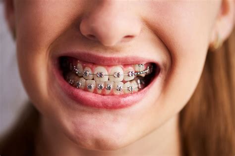 How Do Orthodontics Work? - Newcastle Dental Care
